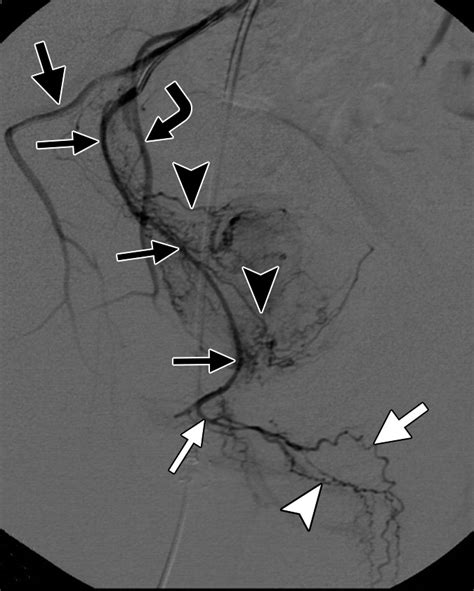 Angiographic Anatomy Of The Male Pelvic Arteries Ajr