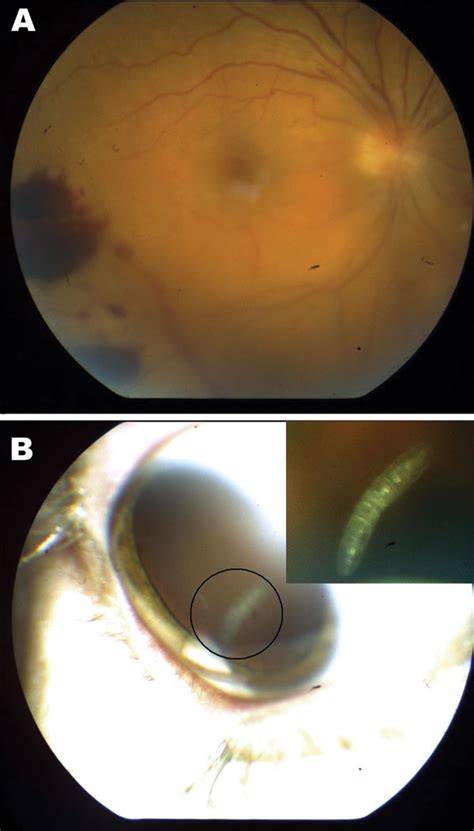 Figure 1 Human Ophthalmomyiasis Interna Caused By Hypoderma Tarandi
