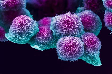 Pancreatic Cancer Linked To Disrupted Circadian Clocks In Cells New