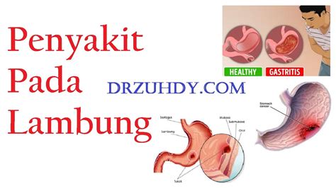 Jenis Penyakit Yang Dapat Terjadi Pada Lambung DrZuhdy