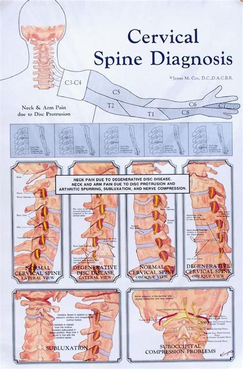 Cervical Spine Nerve Chart Radiating Pain My Xxx Hot Girl