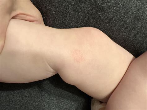 Persistent Ringworm Rdermatologyquestions