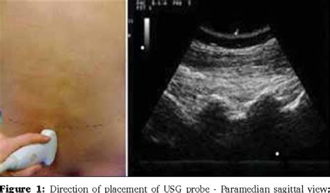 Figure 1 From Comparison Of The Time Taken For Subarachnoid Block Using Ultrasound Guided Method
