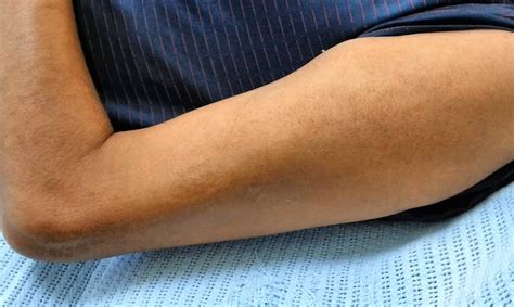 33 Facts About Fasciculation