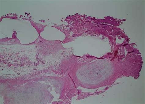 Histologic Evaluation Of Extruded Implants On Hematoxylin Eosin