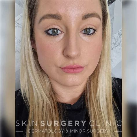 Kirstys Upper Eyelid Surgery Skin Surgery Clinic