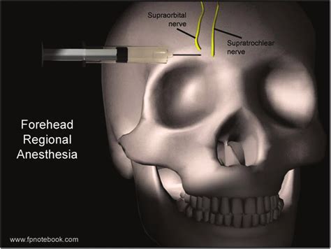 Site Of Injecting For Supratrochlear And Supraorbital Nerve Block