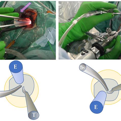 Photographs Of The Endoscopic Keyhole Approach And Schemas Showing The