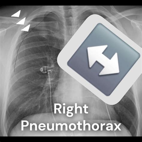 Right Pneumothorax Youtube