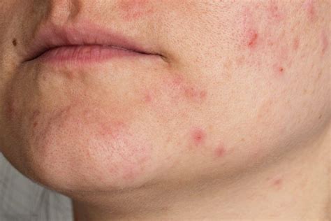 What You Need To Know About Adult Acne And 6 Ways To Treat It Stay At