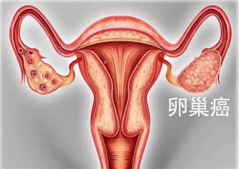 【高尚健康】警惕“沉默的杀手”—卵巢癌，大多数一发现就是晚期 知乎
