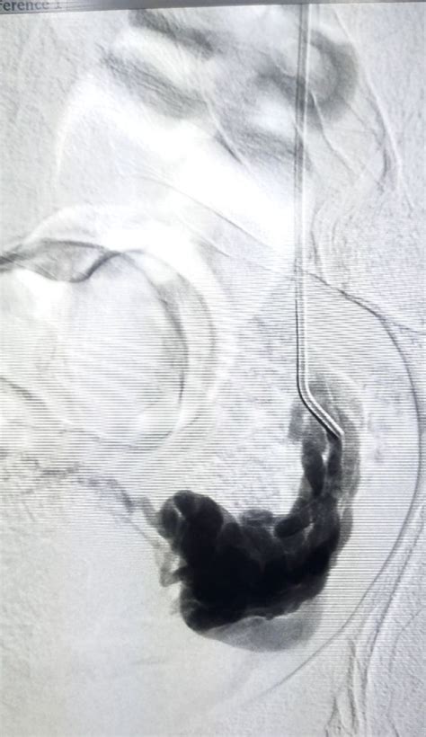 Dr Mahmoud Salah On Linkedin Health Vascularsurgery Endovascular