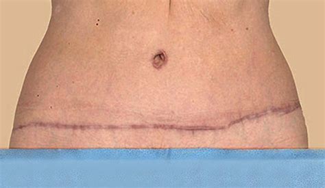 Belly Button Before After Photos Atelier Yuwaciaojp