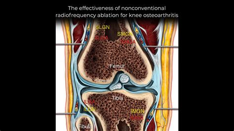 The Effectiveness Of Nonconventional Radiofrequency Ablation For Knee Osteoarthritis Nysora