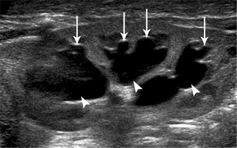 Central And Peripheral Calyceal Dilation On A Prone Sagittal Gray Scale