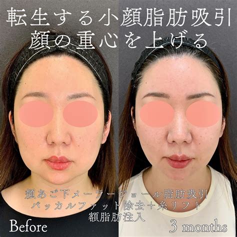 顔の脂肪吸引 Eクリニック大阪院【公式】｜美容整形・美容外科