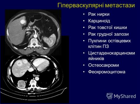 Презентация на тему Компютерна томографія в діагностиці онкологічних