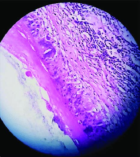 Microscopic Sections Of Right Occipital Brain Cyst Excision Which Is