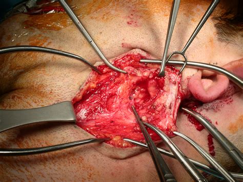 Pyothorax Without Fistula