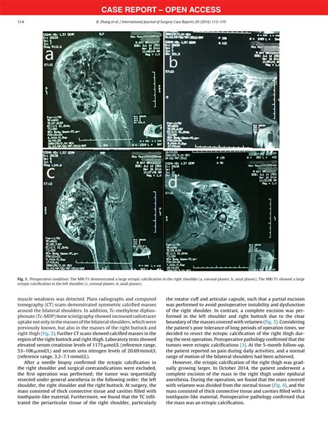 Solution Multiple Ectopic Calcifications In Subcutaneous Tissues With