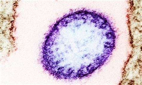 Lets Know Nipah Virus Symptoms And Treatment Nipah Virus Symptoms In