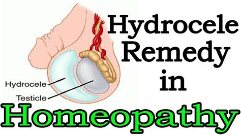 Hydrocele Treatment Service Prescription In Noida Id 27153957373