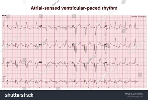 Electrocardiogram Show Atrial Sensed Ventricular Paced Rhythmasvp
