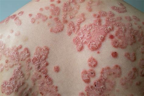 Understanding Guttate Psoriasis Causes Symptoms And Treatment Options