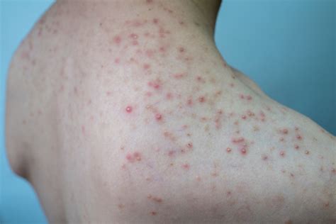 Prevenir Y Tratar La Foliculitis De Forma Natural