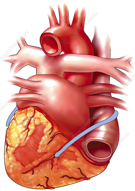 Saphenous Vein Graft Illustration Stock Image C0593239 Science