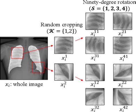 figure 2 from one class classifier for chest x ray anomaly detection