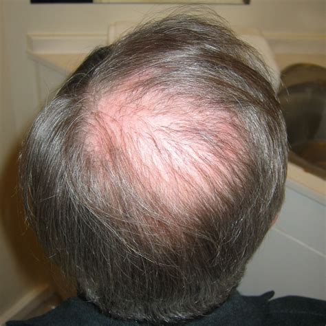 Crown Hair Transplant London Wimpole Clinic Harley St