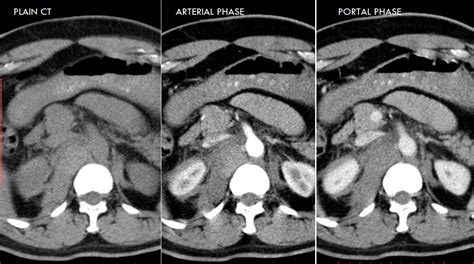 Ultimate Radiology Active Arterial Extravasation In Blunt Abdominal