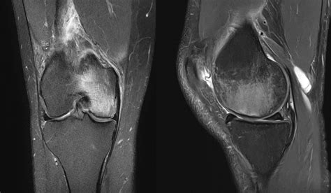 Co To Jest Sonk Lub Sifk Biegajacyortopedapl