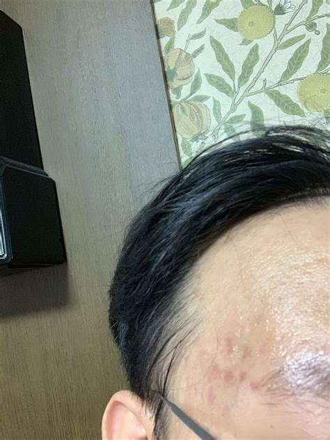 Hematoma After Subcision Acne Scars Forum