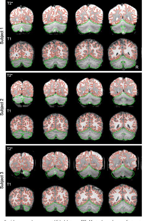 Figure 2 From The Organization Of The Human Cerebellum Estimated By