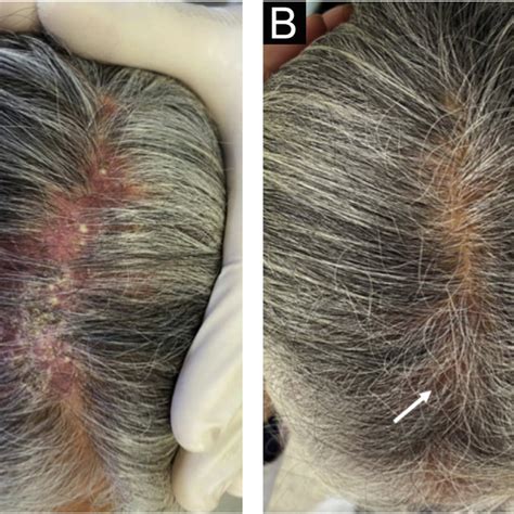 Trichophyton Tonsurans A Microbiological Culture B Thin And Download Scientific Diagram