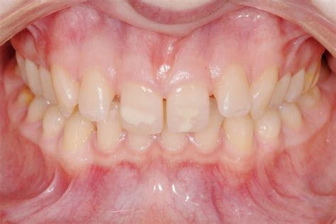 Sonuçların Kalıcılığı Win Lingual Ortodontik Braketlerin Avantajı