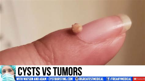 How To Tell If A Lump Is Cancer Or A Cyst At Hillary Mccarty Blog