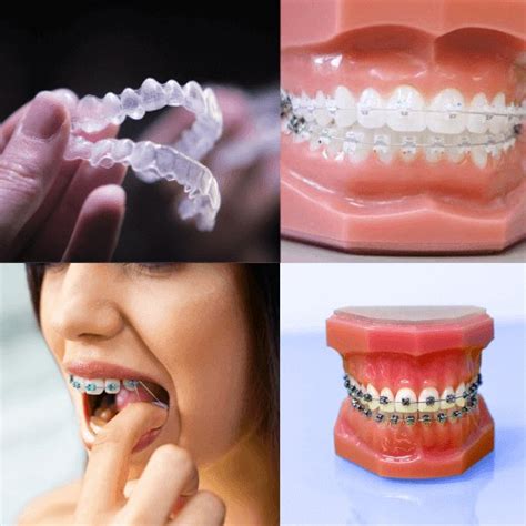 Braces What Options Are There Heaton Mersey Orthodontics