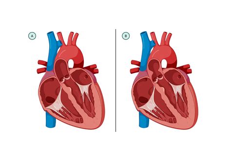Supravalvular Aortic Stenosis Svas Biorender Science Templates
