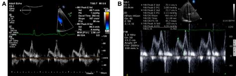 A Echo Doppler Of Mitral Valve Inflow Showed Left Ventricular
