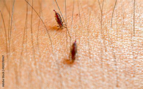 Can Head Lice Live On Your Skin At David Oldham Blog