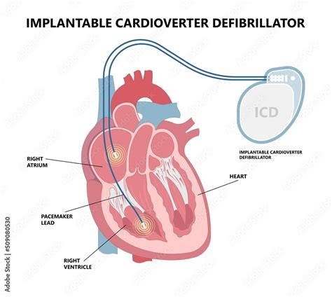 Pacemaker Icd Implantable Cardioverte Defibrillator Pulse Generator Stimulate Of Heart Prevent