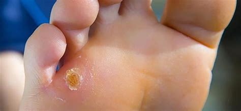 Corns Treatment
