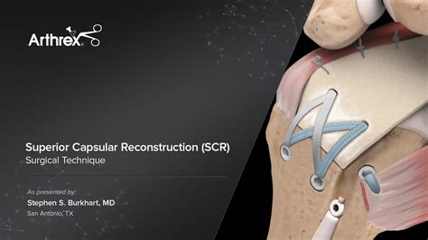 Arthrex Superior Capsular Reconstruction Scr