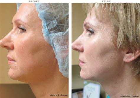 Ultherapy Before And After Pictures Dr Turowski Plastic Surgery