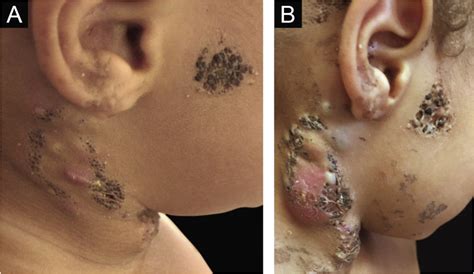 Extensive Unilateral Nevus Comedonicus With An Inflammatory Component Pmc