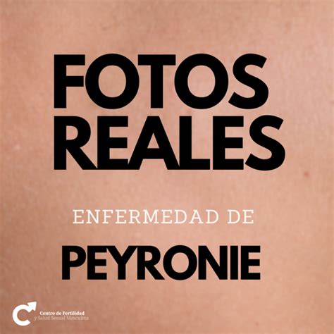 Enfermedad De Peyronie Fotos