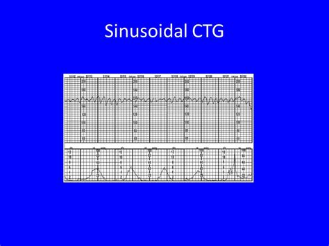 Ctg Interpretation And Management Ppt Video Online Download